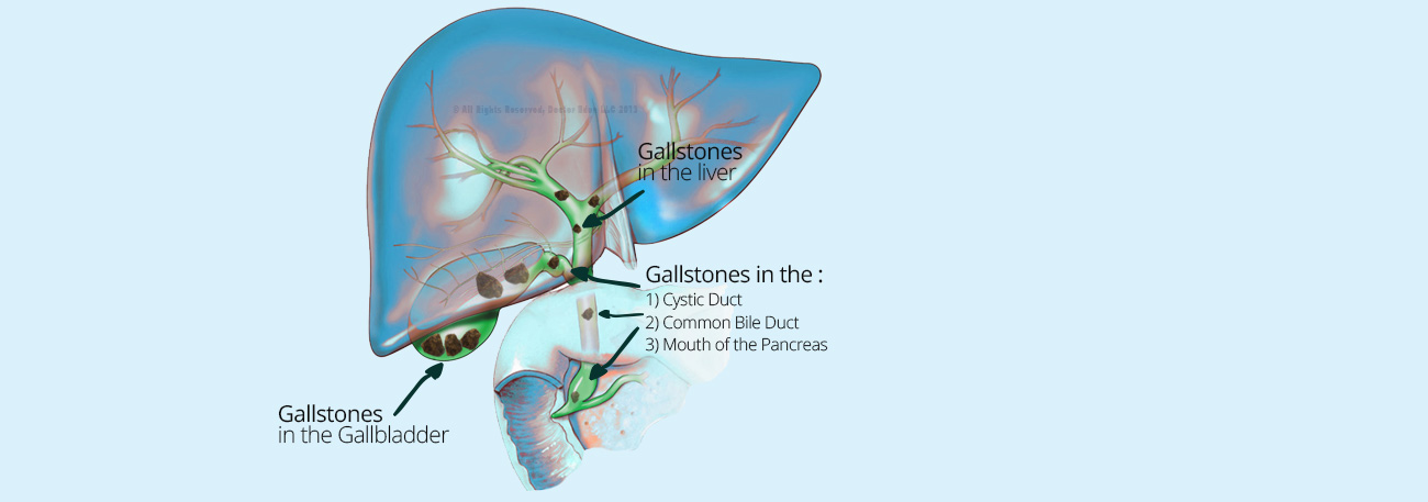 Gallbladder Sludge | Pulverexx Benefits & Overview in Canada & the USA!