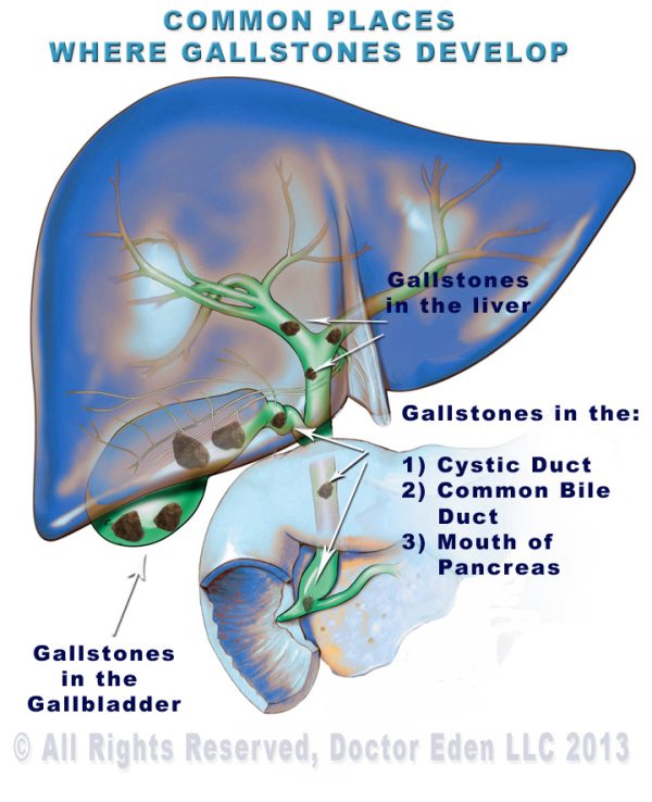 Common Places Where Gallstones Develop - Remove Gallstones Without Surgery